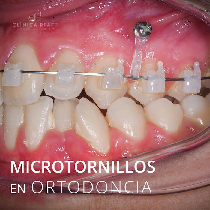 Blog Dental de Clínica Pfaff - Noticias sobre odontología | Barcelona