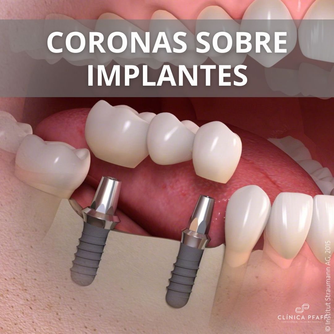 Todo sobre las coronas sobre implantes - Pfaff Clínica Dental Barcelona