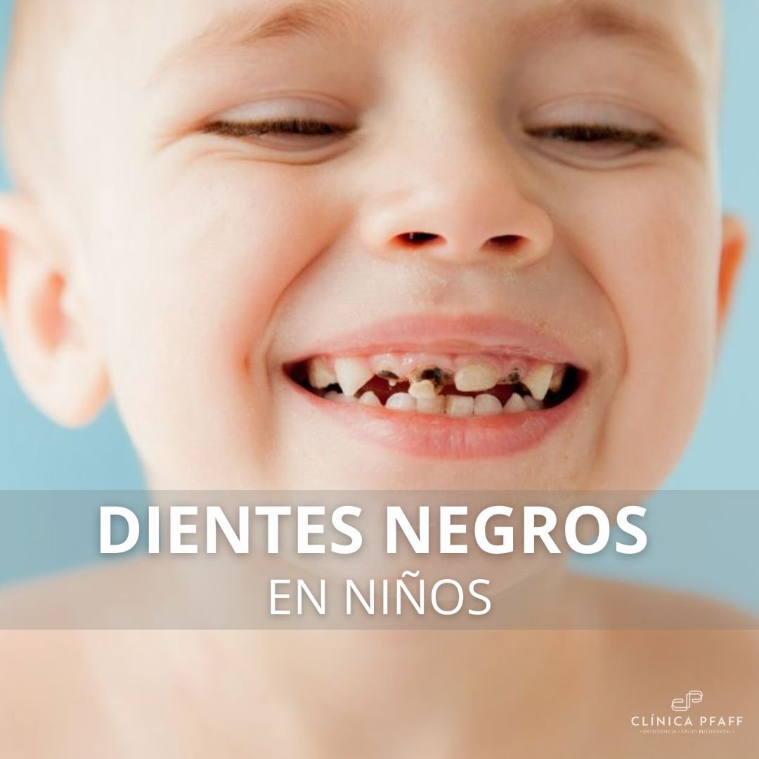 Dientes negros en niños, ¿qué hacer? | Pfaff Clínica Dental Barcelona