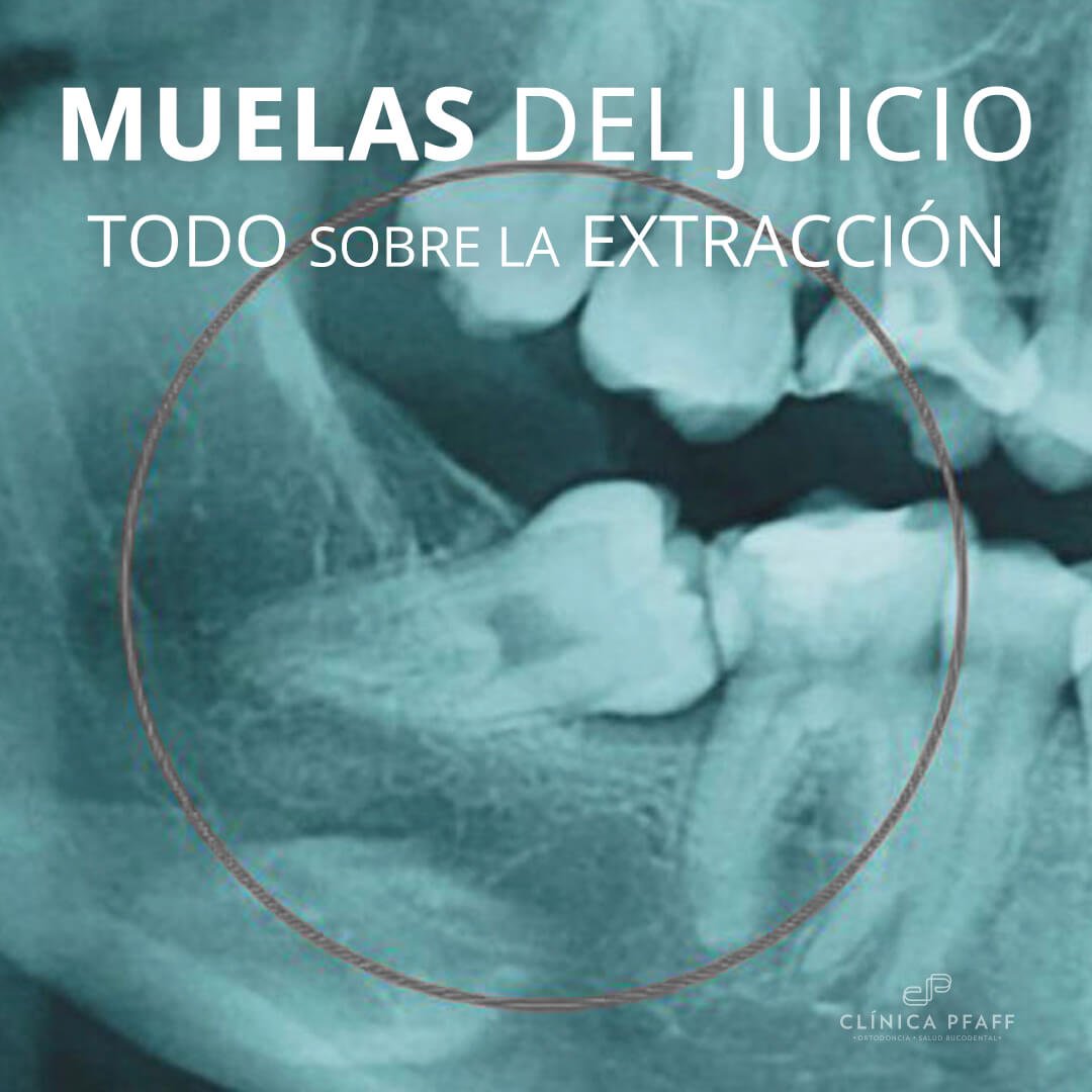 Muelas del juicio: La extracción | Pfaff Clínica Dental Barcelona